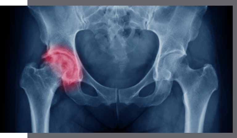 Snapping Hip Syndrome Guide | Easthill Physiotherapy & Acupuncture