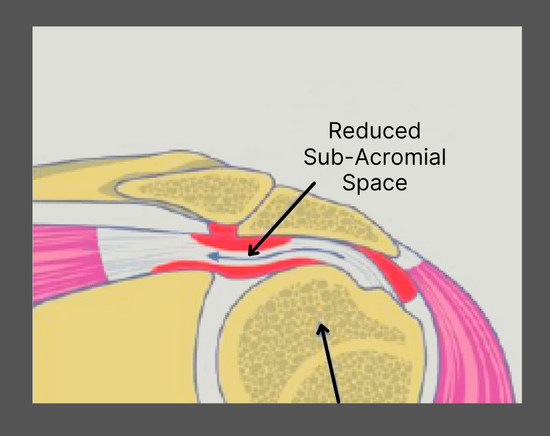 Shoulder Impingement Guide | Easthill Physiotherapy & Acupuncture
